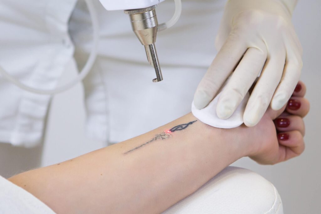 Surgical Tattoo Removal:Benefits and What To Expect - Vegas Liposuction