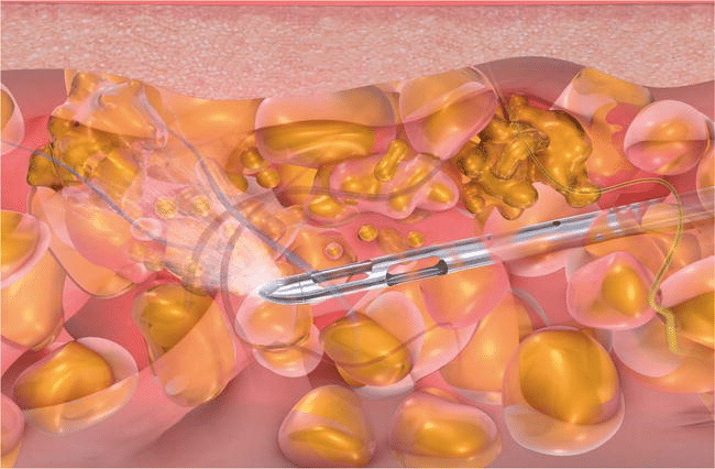 Tumescent Technique Benefits: Principles & Procedures of Liposuction ...