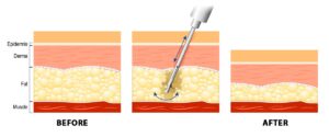 Understanding Tumescent Solution Variations: Composition and ...