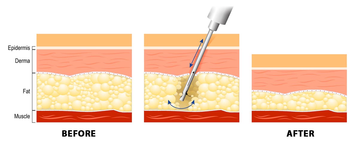 Understanding Tumescent Solution Variations: Composition and ...